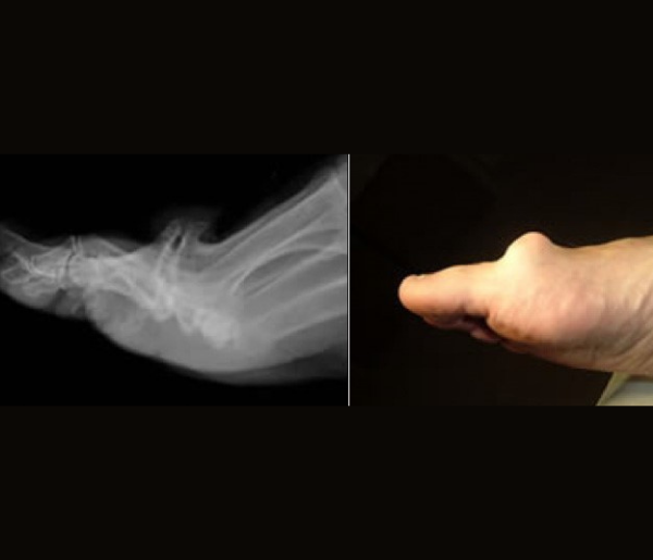 Heel Spur Syndrome - Denton Foot & Ankle Surgical Specialists